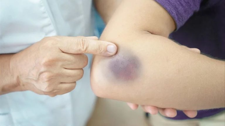 Medicina forense: evolución de la equimosis | LP