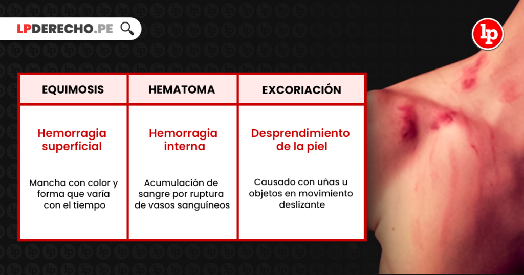 Diferencias entre equimosis, hematoma y excoriación | LP