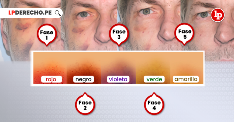 Medicina forense: evolución de la equimosis | LP